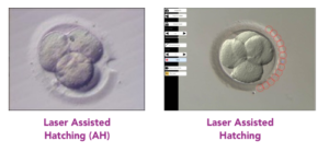 Laser Assisted Hatching - Fertility Institute of San Diego